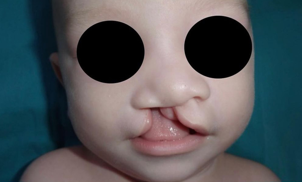 Yarık Dudak – Damak Rekonstruksiyonu - Op. Dr. Ozan Can Canbolat